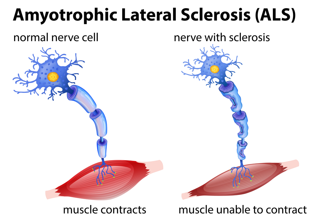 Amyotrophic Lateral Sclerosis ALS Causes And Symptoms Amyotrophic Lateral Sclerosis ALS Causes And Symptoms